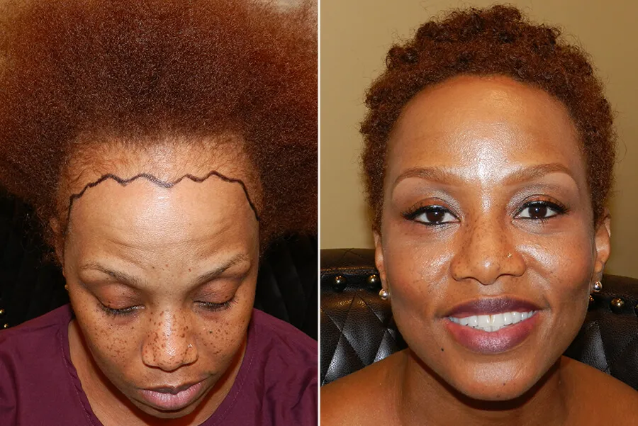 Hair Transplant Bay Area