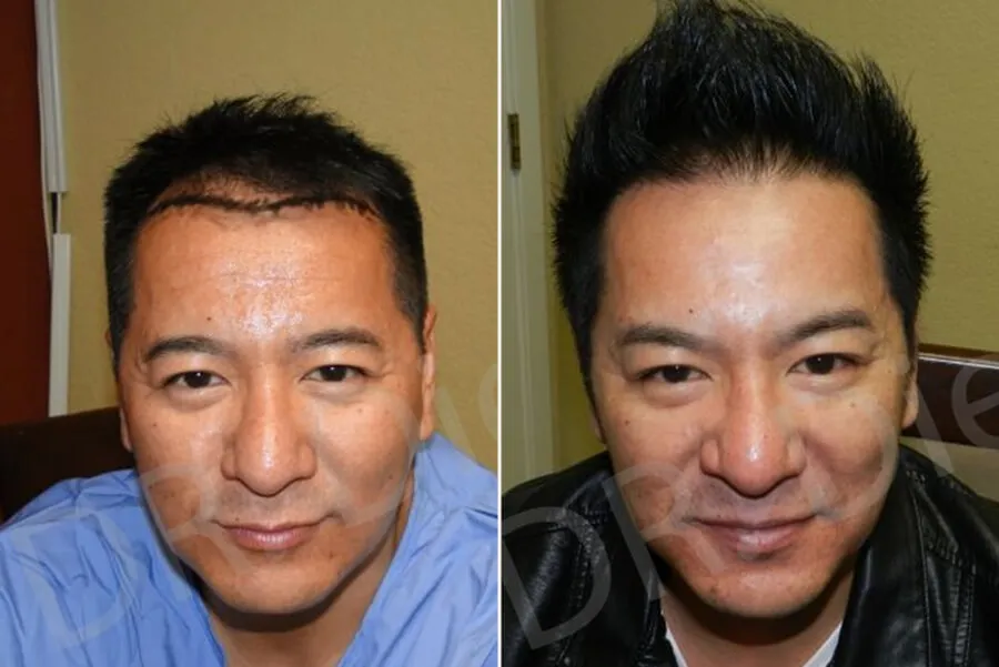 Dr. John Diep Hair Transplant - Natural Hair Restoration Experts