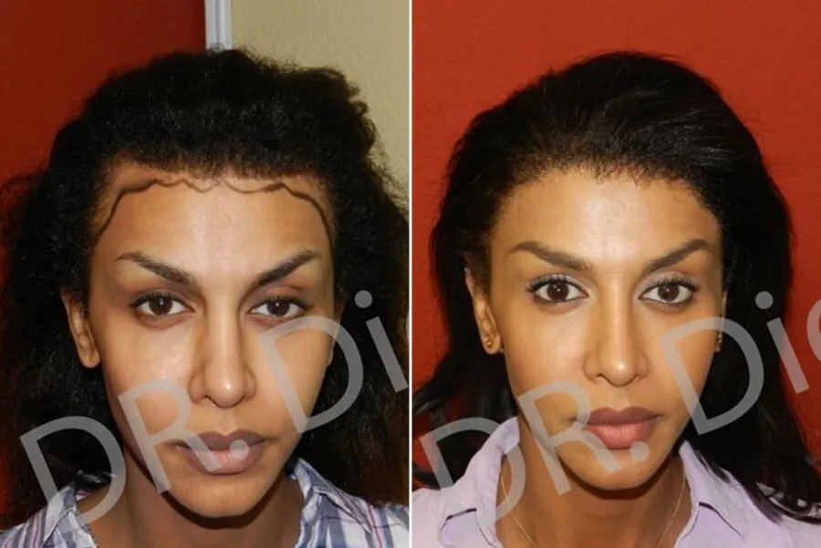 Dr. John Diep Hair Transplant - Natural Hair Restoration Experts