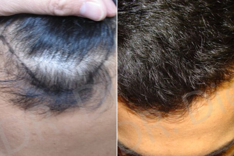Dr. John Diep Hair Transplant - Natural Hair Restoration Experts